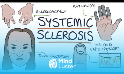 Learn Systemic Sclerosis and Scleroderma Visual Explanation for ...