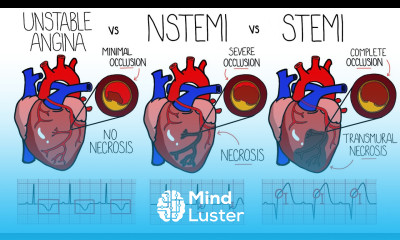 Learn Acute Coronary Syndrome Heart Attack Unstable Angina vs NSTEMI vs ...