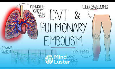 Learn Deep Vein Thrombosis DVT Pulmonary Embolism Explained - Mind Luster