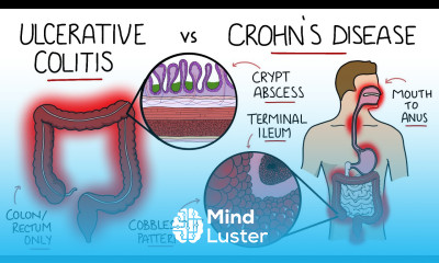 Learn Inflammatory Bowel Disease Ulcerative Colitis v Crohn s Disease ...