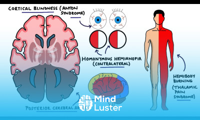 Learn Posterior Cerebral Artery Stroke Syndromes PCA Stroke Syndromes ...