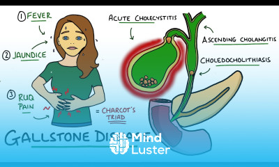 Learn Gallstone Disease Acute Cholecystitis vs Cholelithiasis vs ...