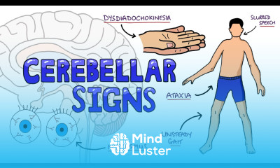 Learn Cerebellar Dysfunction Signs Mnemonic DANISH What are the Signs ...