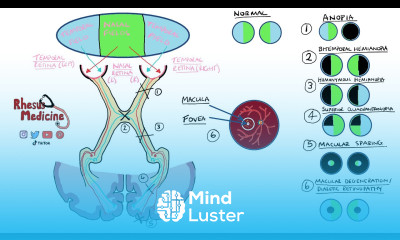 Learn Visual Field Defects and Optic Nerve Pathway Homonymous ...