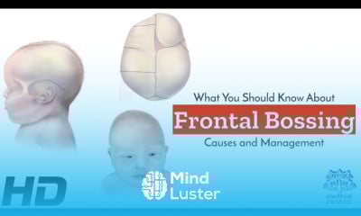 Learn Unlocking Frontal Bossing Causes Management and What You Need to ...