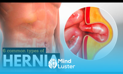 Learn Hernia Breakdown Discovering the 6 Most Prevalent Types - Mind Luster