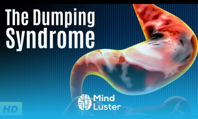 Learn The Dumping Syndrome Everything You Need To Know - Mind Luster