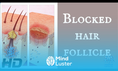 Learn Blocked Hair Follicle – Everything You Need To Know - Mind Luster