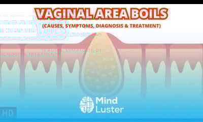 Learn Dealing with Vaginal Area Boils Tips and Advice for Fast Relief ...