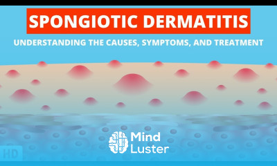 Learn The Itchy Truth Spongiotic Dermatitis Unveiled - Mind Luster