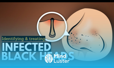Learn Infected Blackheads What Your Skin Is Trying to Tell You - Mind ...