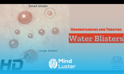 Learn Water Blister Breakdown What Your Body Is Telling You - Mind Luster