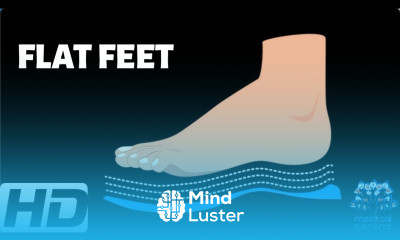 Learn FLAT FEET Everything You Need To Know - Mind Luster