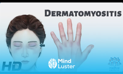 Learn Dermatomyositis Everything You Need To Know - Mind Luster
