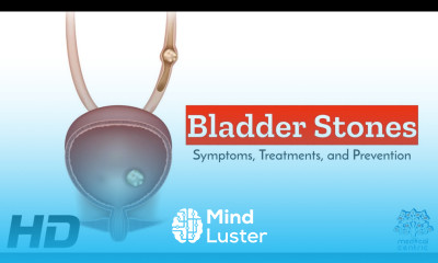 Learn Bladder Stones Symptoms and Your Path to Relief - Mind Luster