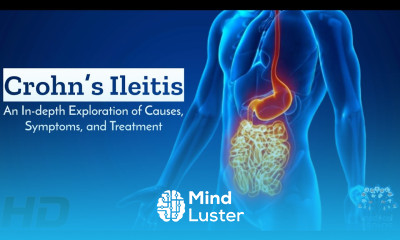 Learn Crohn s Ileitis Unveiled Causes Symptoms and Treatment Explored ...