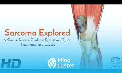 Learn Sarcoma Decoded A Full Spectrum Guide on Causes Types and ...