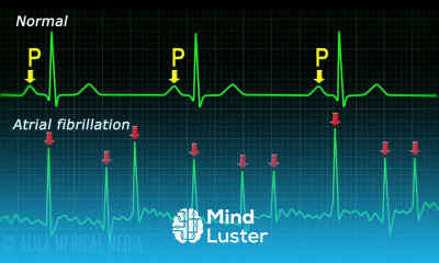 Learn Atrial Fibrillation Anatomy ECG and Stroke Animation - Mind Luster