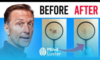 Learn How To Remove Skin Tags And Warts Overnight - Mind Luster