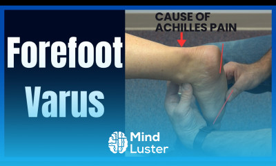 Learn Forefoot Varus Evaluation - Mind Luster