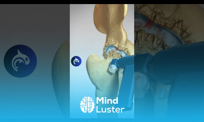 Learn Total Hip Replacement Arthroplasty 3D Animation - Mind Luster