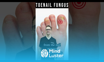 Learn How to Know If Toenail Fungus is Dying How Fast Do Nails Grow ...