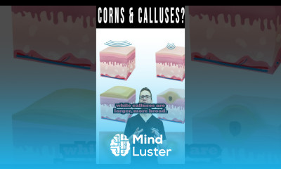 Learn Foot CORNS CALLUSES How To Get Rid Of Them For Good - Mind Luster