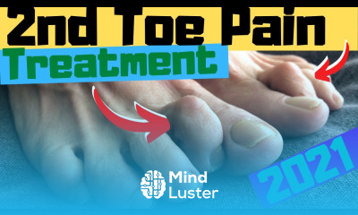 Learn 2nd Toe Capsulitis Claw Toe Hammer Toe RELIEF Taping Treatment ...