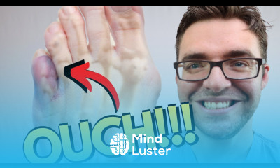 Learn What To Do For A Broken Pinky Toe How To Tape Little Toe ...