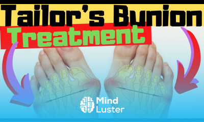 Learn Tailor s Bunion Bunionette Pads Correctors Treatment Surgery ...