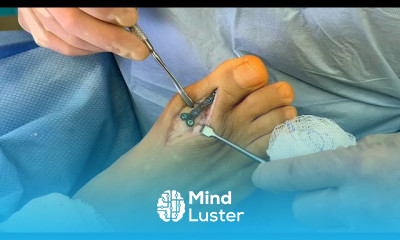 Learn First Metatarsal Phalangeal Joint MTP Fusion with Plate - Mind Luster