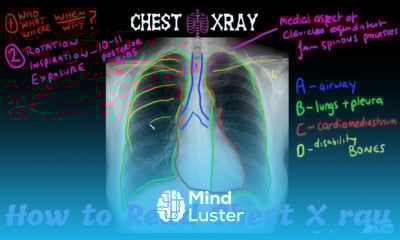 Learn How to Read Chest X ray Medical Technology - Mind Luster